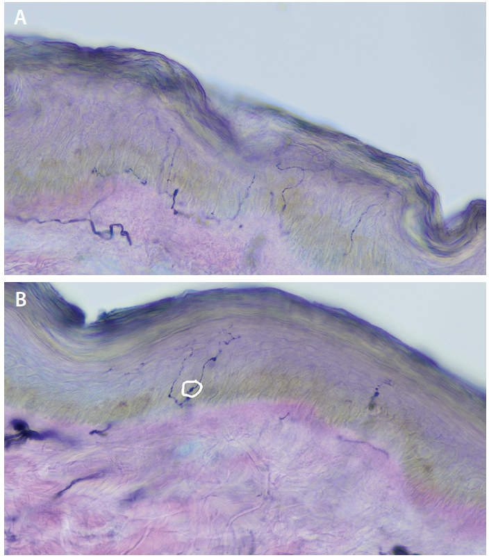 Utility of Skin Biopsy in Neuromuscular Disease