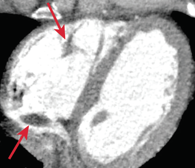 Stroke Spotlight: Hypercoagulable States in Ischemic Stroke