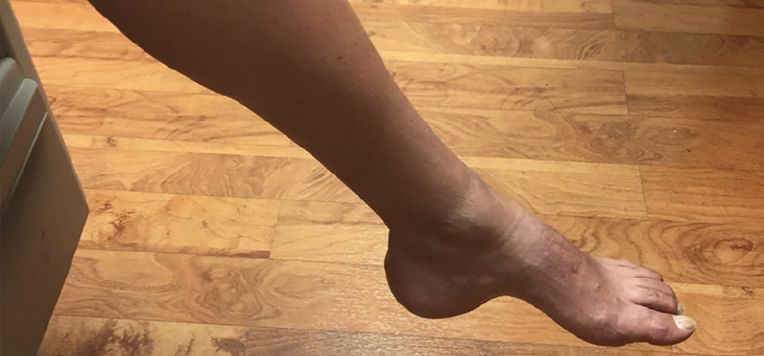 Challenge Case Report: Weakness and Wasting of the Left Foot