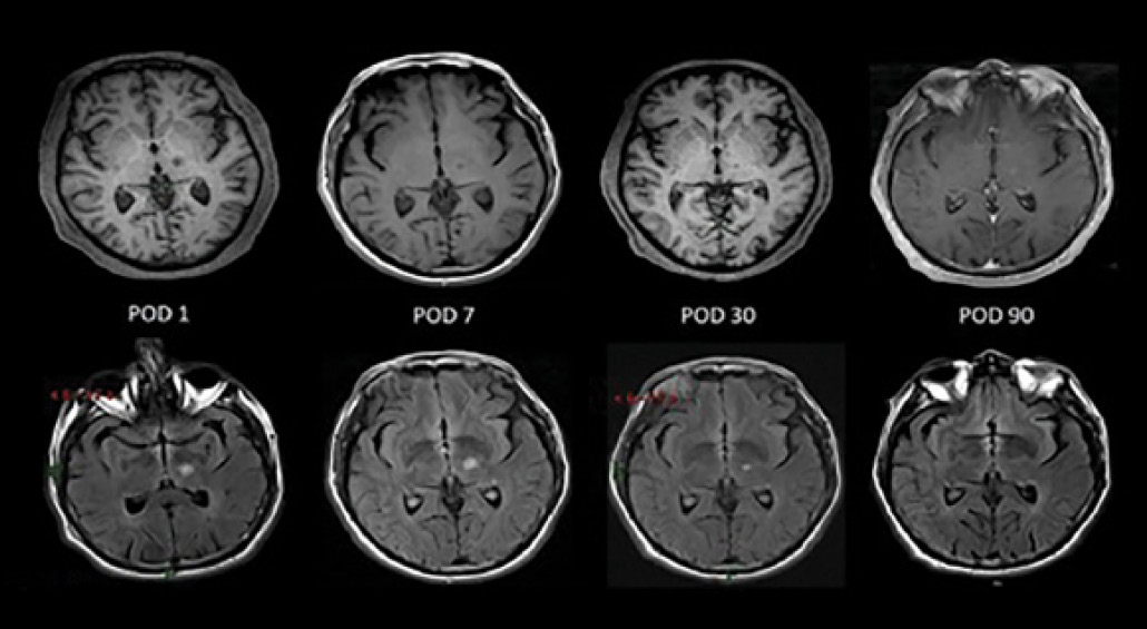 Surgical Interventions for Parkinson's Disease