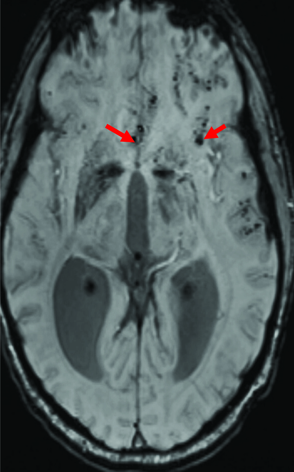 Triaging Symptomatic Amyloid-Related Imaging Abnormalities
