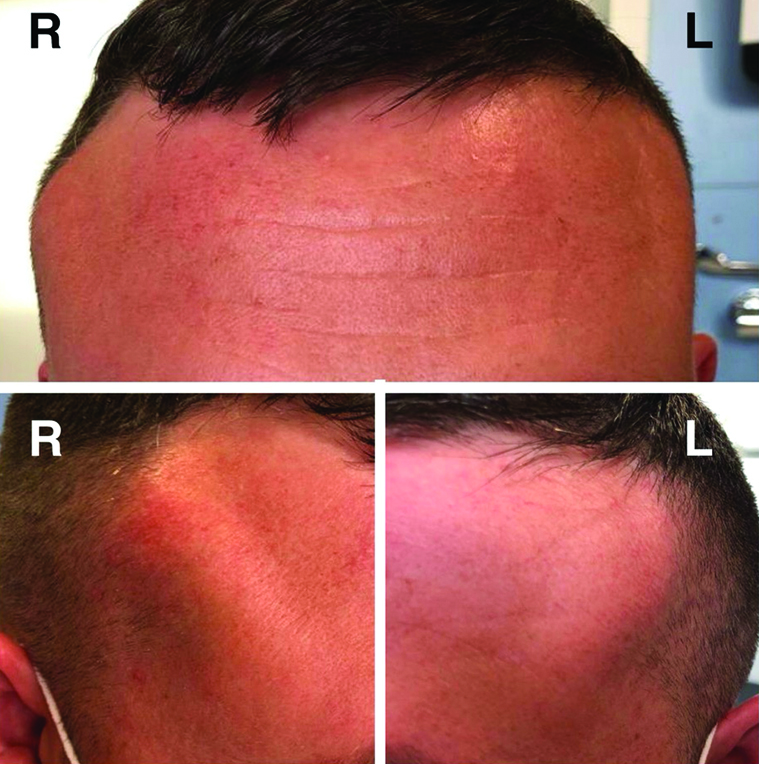 Bilateral Temporalis Muscle Hypertrophy with Headache, Pain