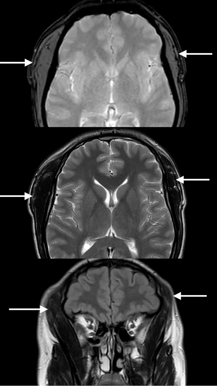 Bilateral Temporalis Muscle Hypertrophy with Headache, Pain