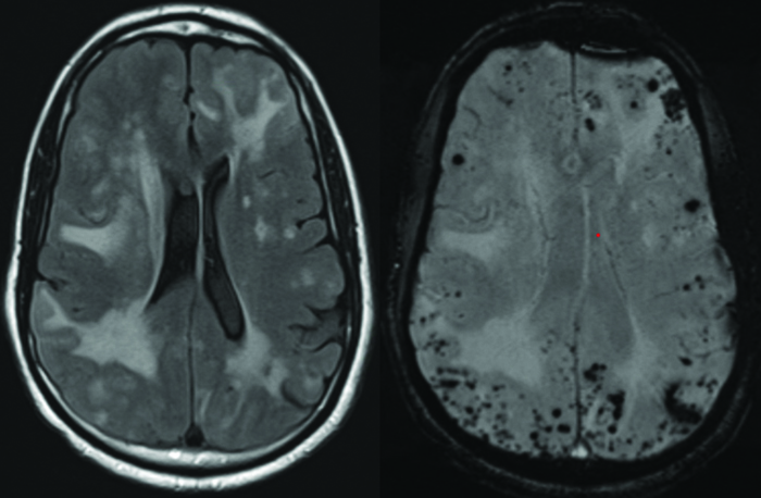 Immune Stroke: Inflammatory Cerebrovascular Disorders