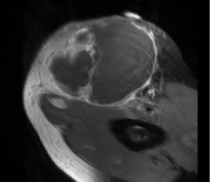 Care of Individuals with Neurofibromatosis Type 1