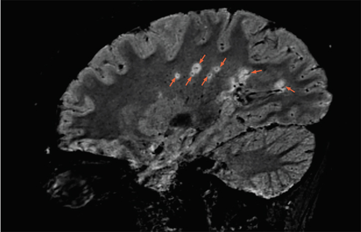 An Example of the Central Vein Sign