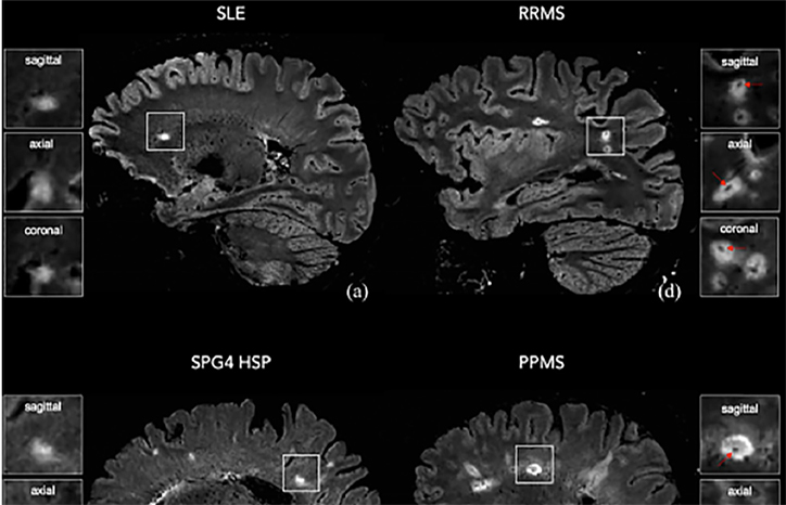 The Central Vein Sign