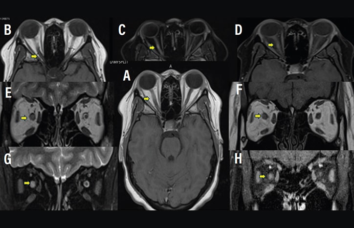 Neuro-Ophthalmology Notions: The Optic Nerve as Topographic