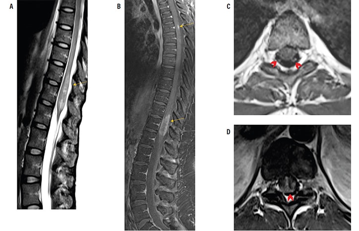 Neuromyelitis Optica Spectrum Disorder With Atypical Imaging
