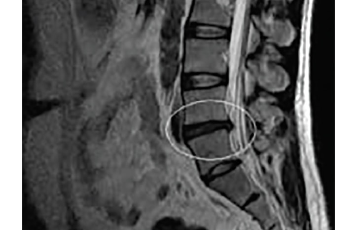 Spinal Pain: Acute & Chronic Management