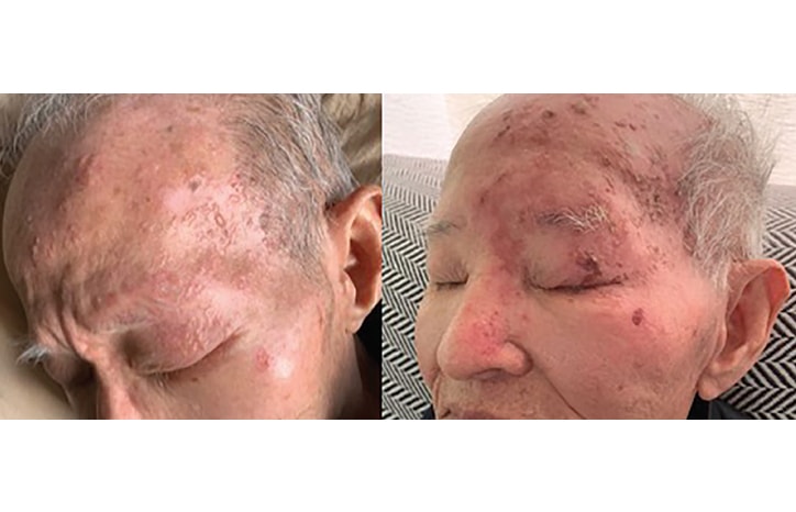 Neuro-ophthalmology Options: Secondary Causes of Eye Pain