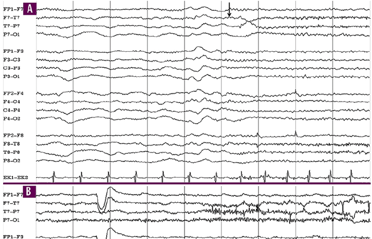 Epilepsy Essentials: VideoEEG Analysis