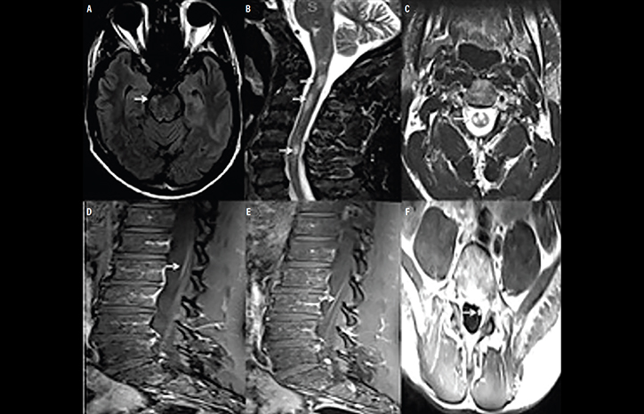 MOG Antibody Disease