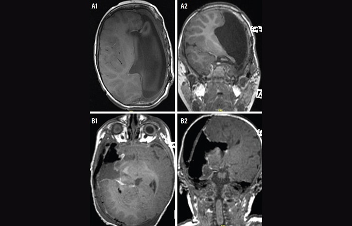 Epilepsy Essentials: Hemispherectomy for Early-Onset Pediatr