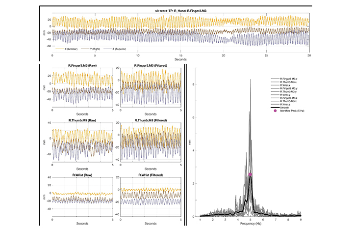 Movement Disorders Moment: Use of 3D Motion Capture for Kine