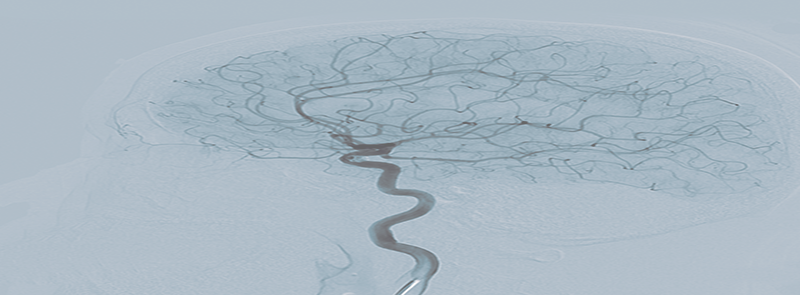 Spinal Cord Infarct: Clinical & Imaging Pearls