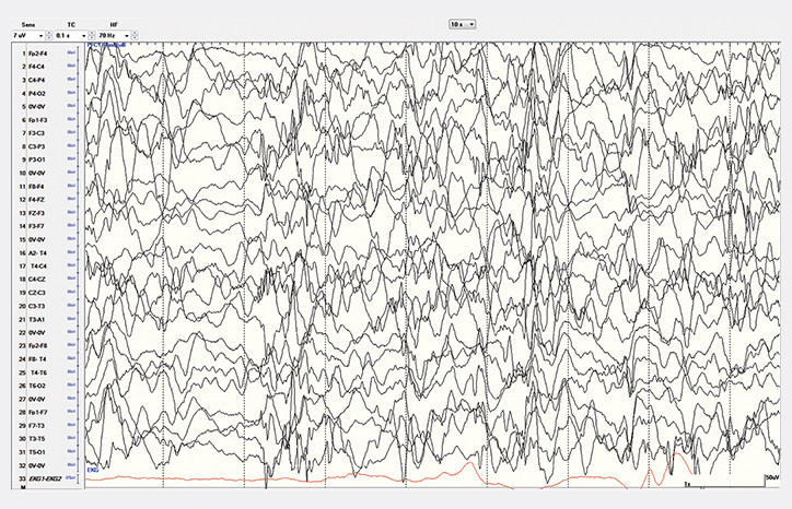 Epilepsy EssentialsInfantile Spasms: The Biggest Little Seiz