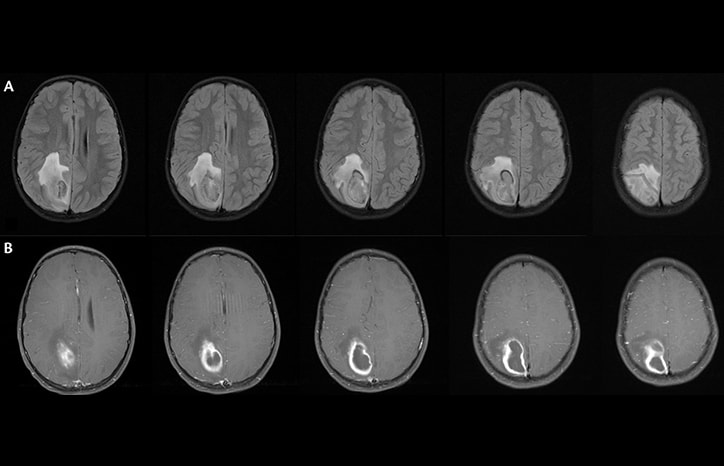 Focal Status Epilepticus 9 Years After Brain Abscess