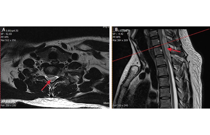 Case Report: Complete Spinal Cord Injury