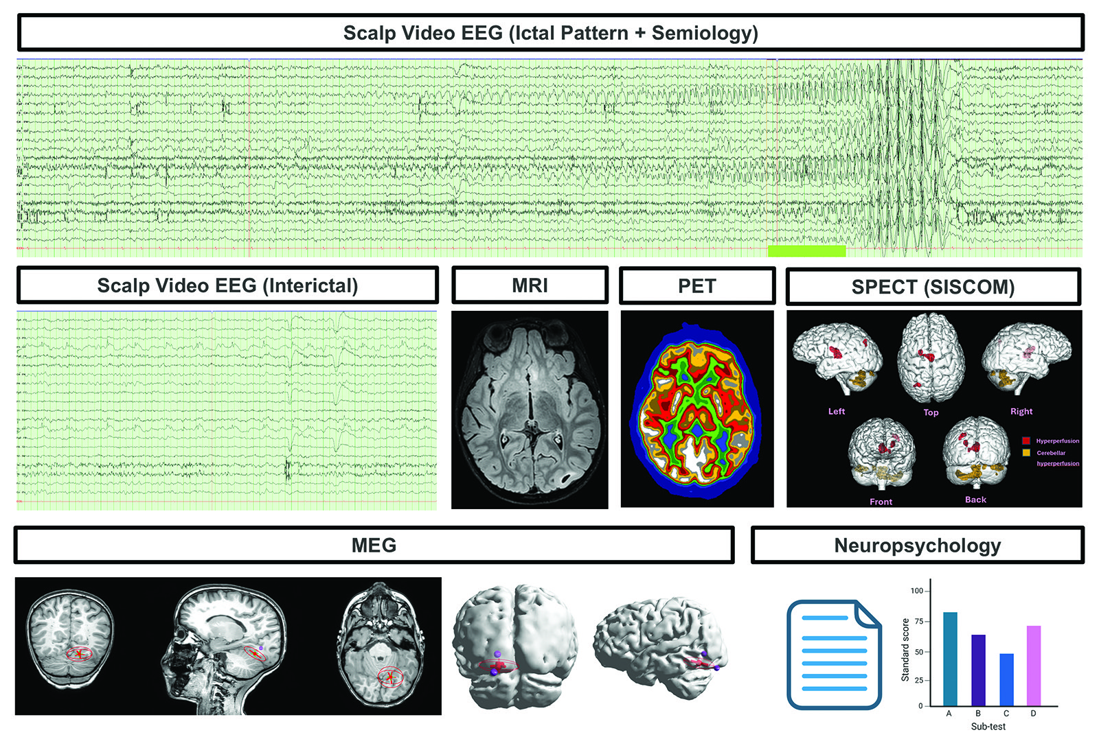 Utility of SEEG in the Treatment of Drug-Resistant Epilepsy