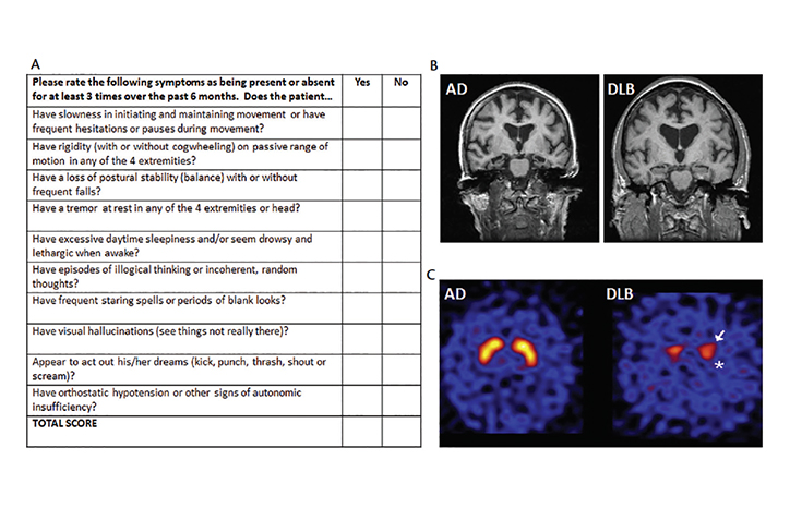 Lewy Body Dementia