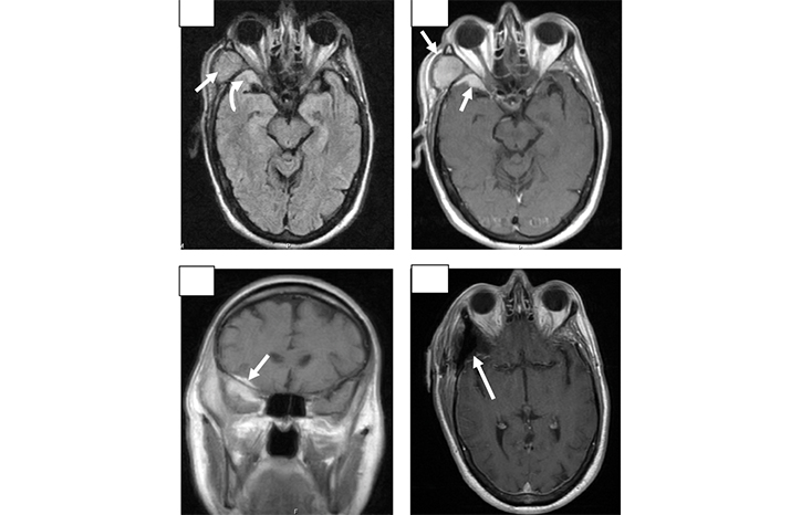 Lesser Wing Of Sphenoid Meningioma Radiology