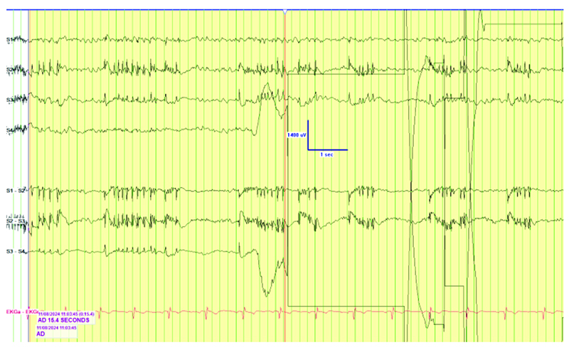 Practical Uses of EEG in the Operating Room