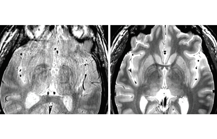 Movement Disorders Moment Asleep Deep Brain Stimulation