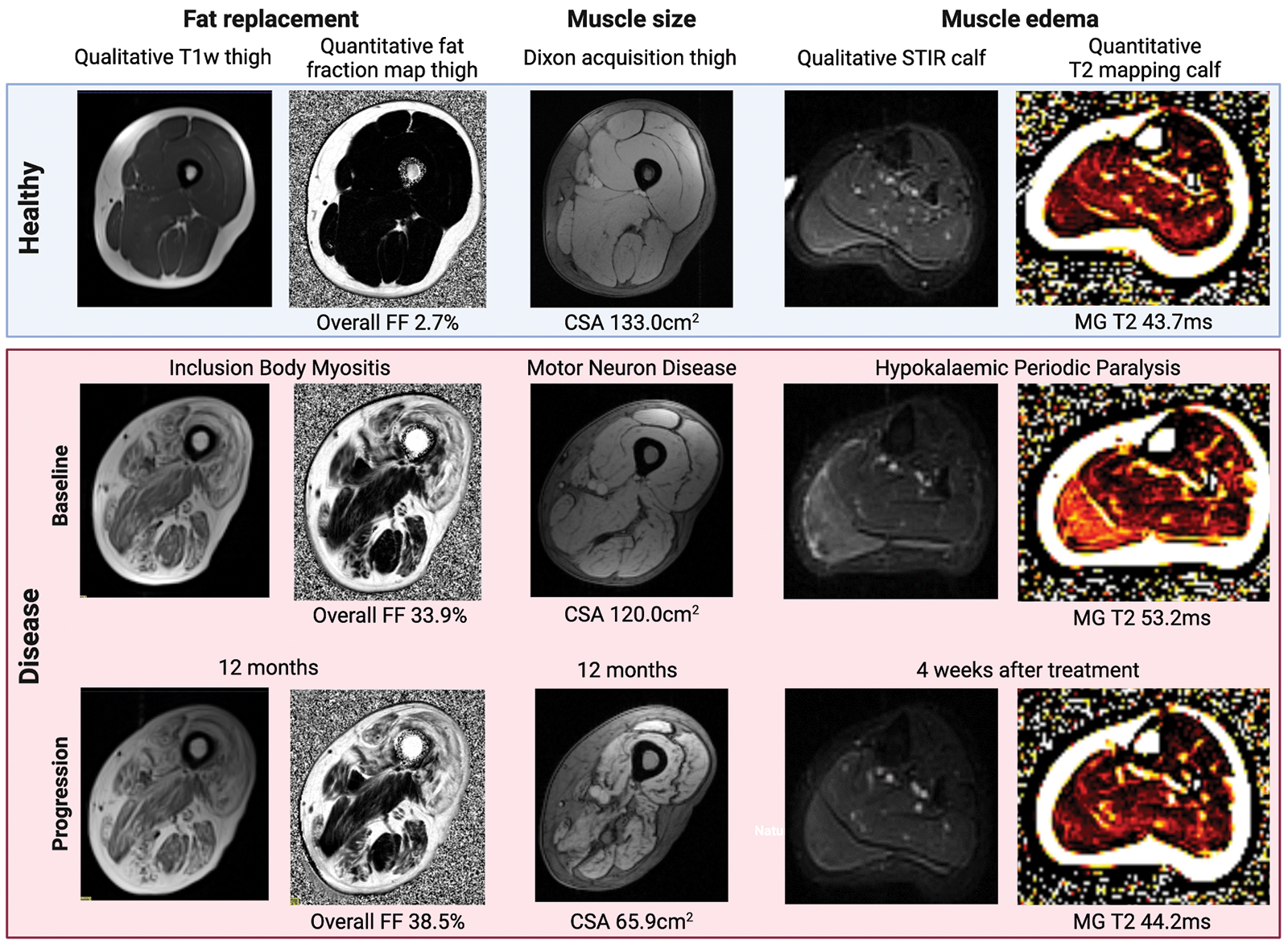 Imaging Outcome Measures in Neuromuscular Diseases