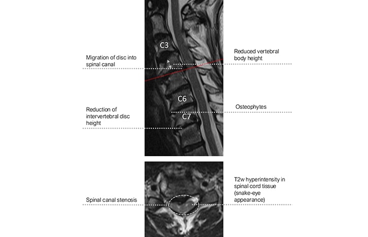 Degenerative Cervical Myelopathy as a Neuromuscular Mimicker