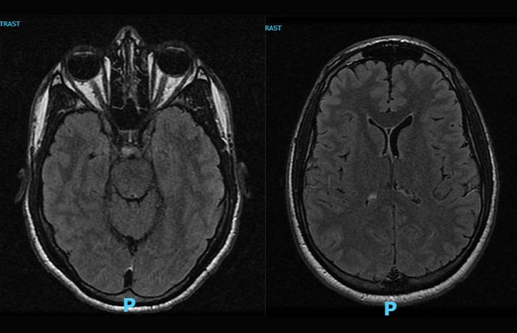 Reversible Cortical Blindness Secondary to Acute Carbon Mono