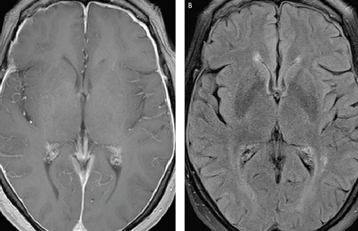 Meningeal Enhancement Seen on Workup for Memory Loss