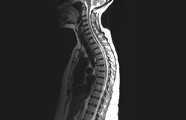 Case Report: Longitudinally Extensive Transverse Myelitis