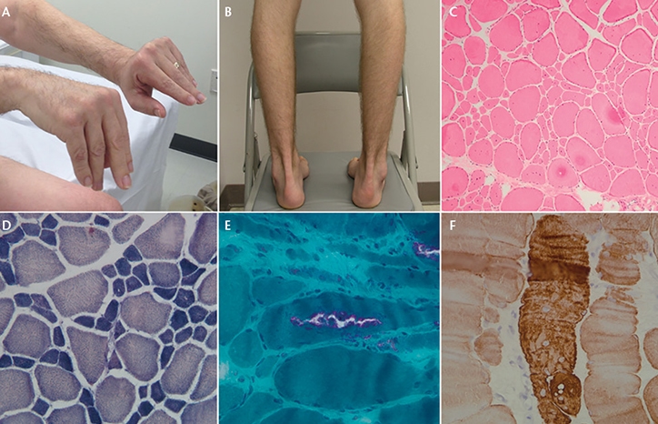 Differential Diagnosis of Distal Myopathies