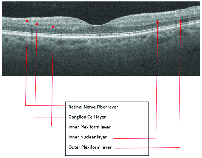 Paraclinical Optic Nerve Tests in Multiple Sclerosis