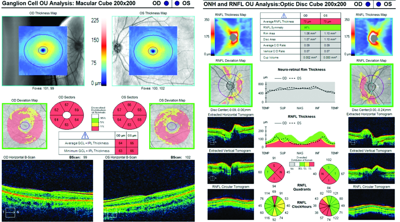 Paraclinical Optic Nerve Tests in Multiple Sclerosis