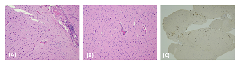 Treatment-Resistant Small Vessel Primary Angiitis of the CNS